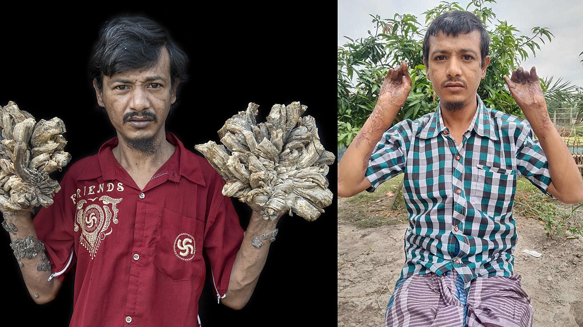 El 'hombre árbol' ya puede abrazar a sus hijas | El Correo